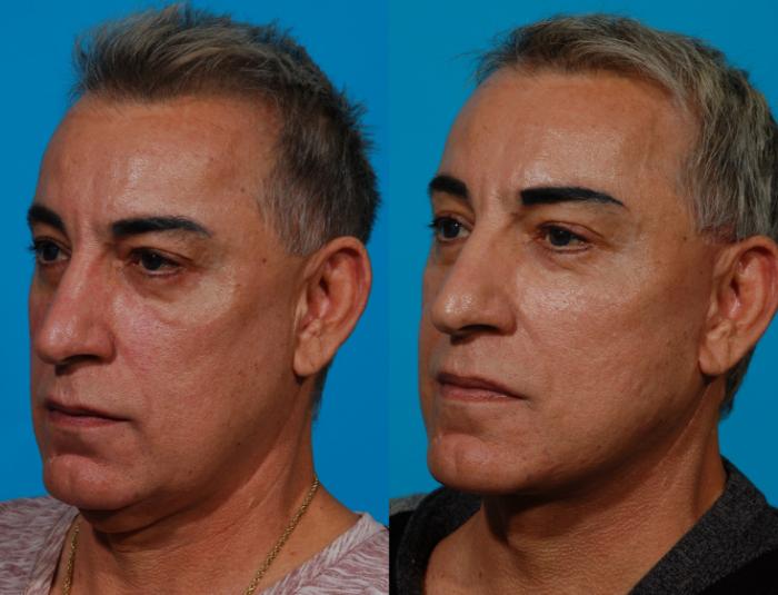 Facelift Before & After Photos Patient 189 | Tucson, AZ | Foothills ...