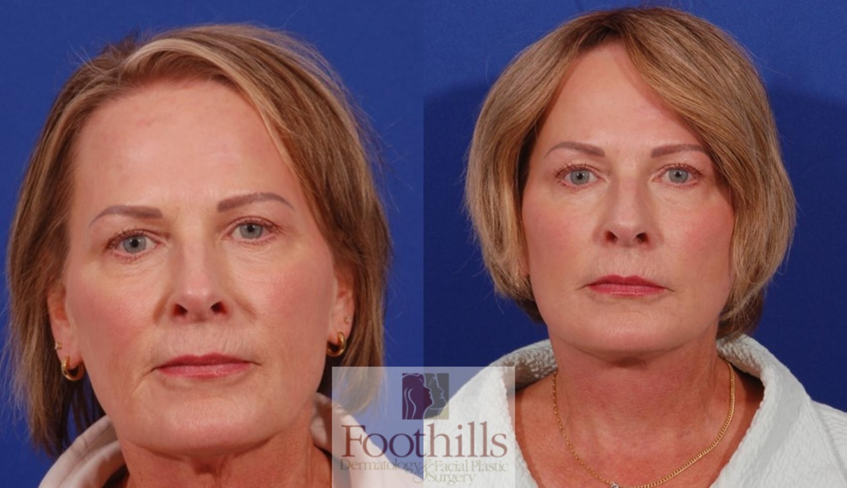 Facelift Before & After Photos Patient 191 | Tucson, AZ | Foothills ...