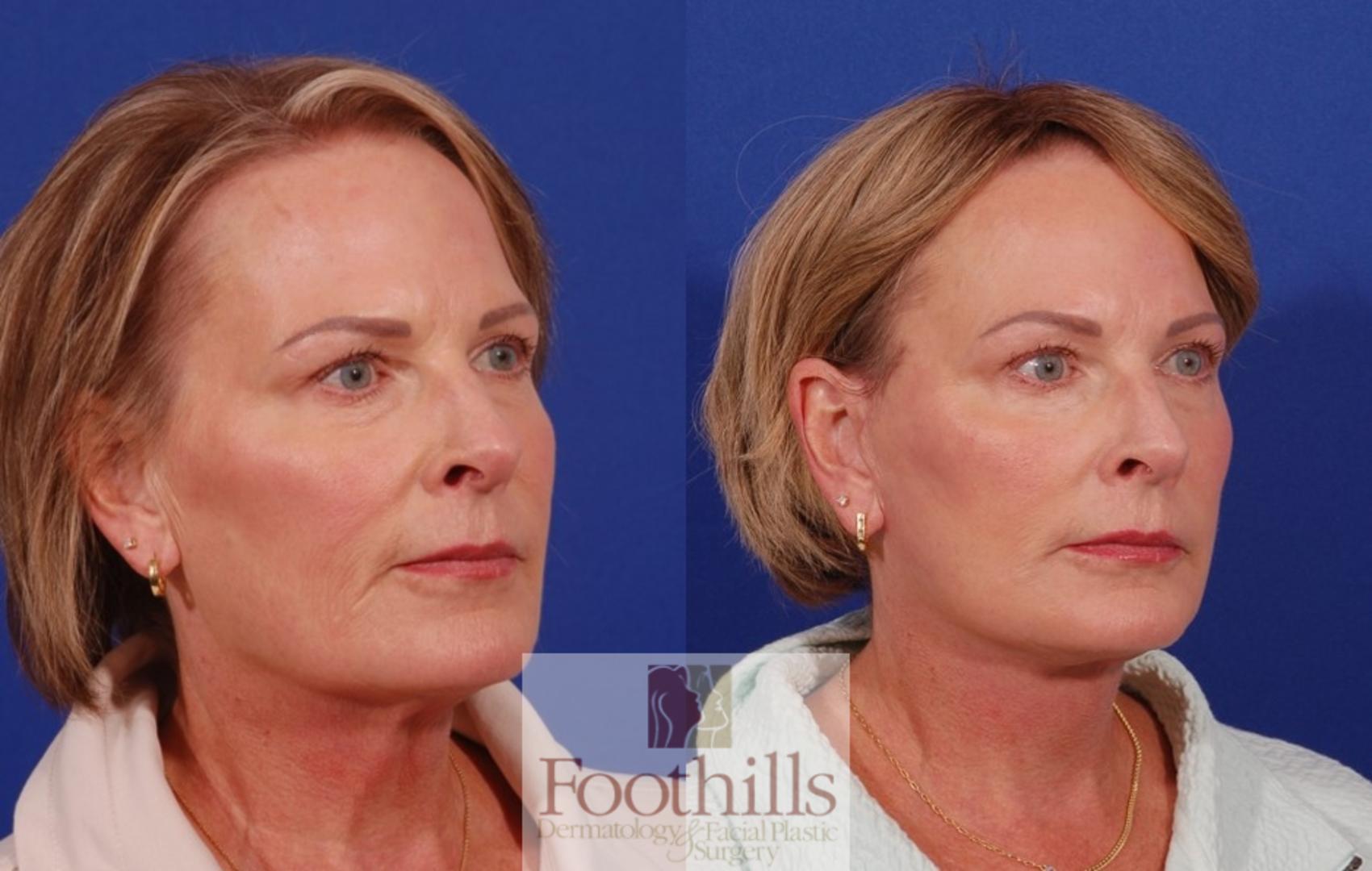 Facelift Before & After Photos Patient 191 | Tucson, AZ | Foothills ...
