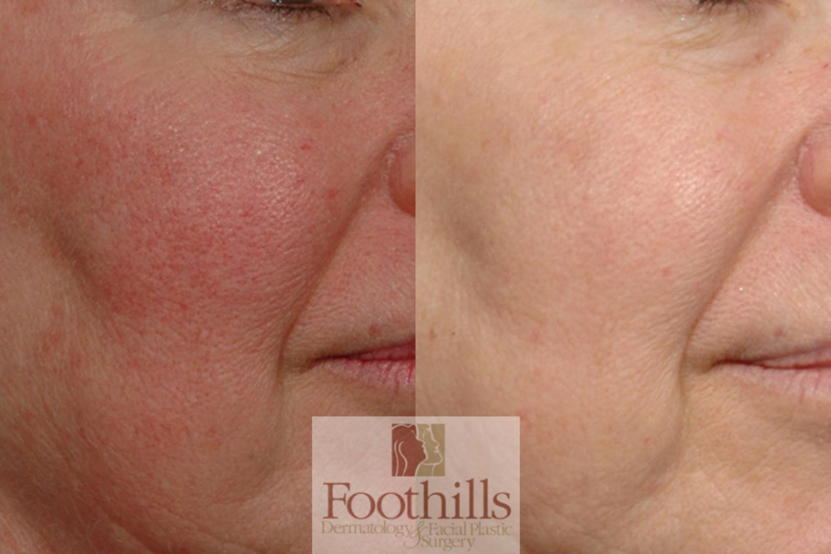 IPL Photofacial Before & After Photos Patient 3 | Tucson, AZ ...